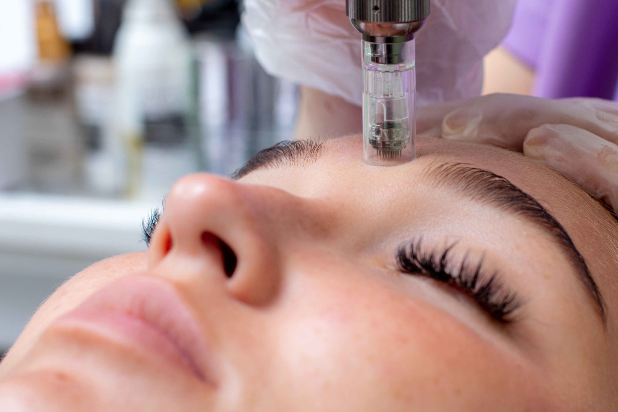 Microneedling In Fredericksburg, VA | Revive Med Aesthetics