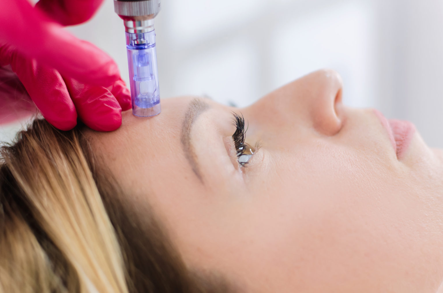 What Is The Microneedling Of The Face? Revive Med Aesthetics